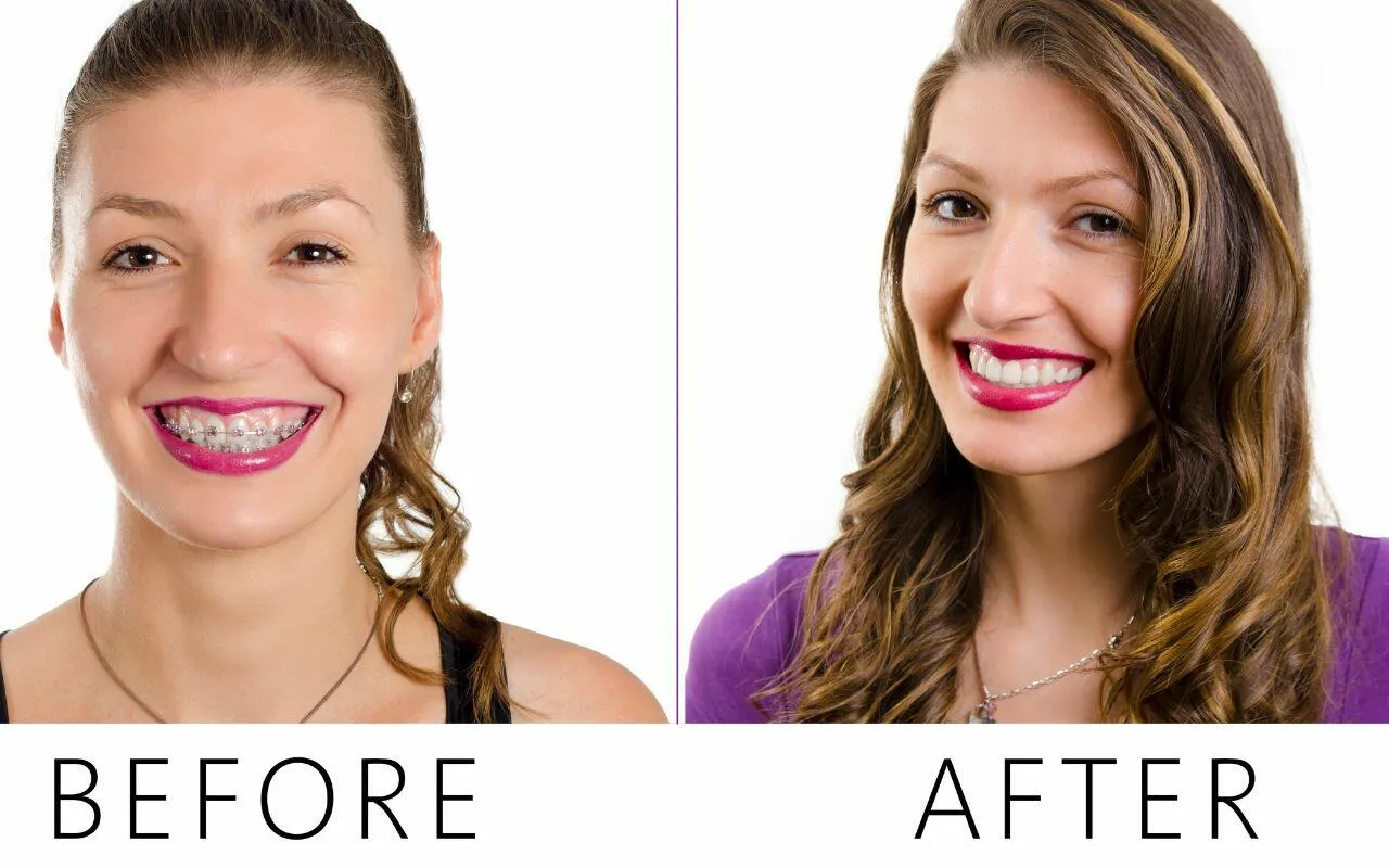 Braces Before And After - Bradford Family Dentistry