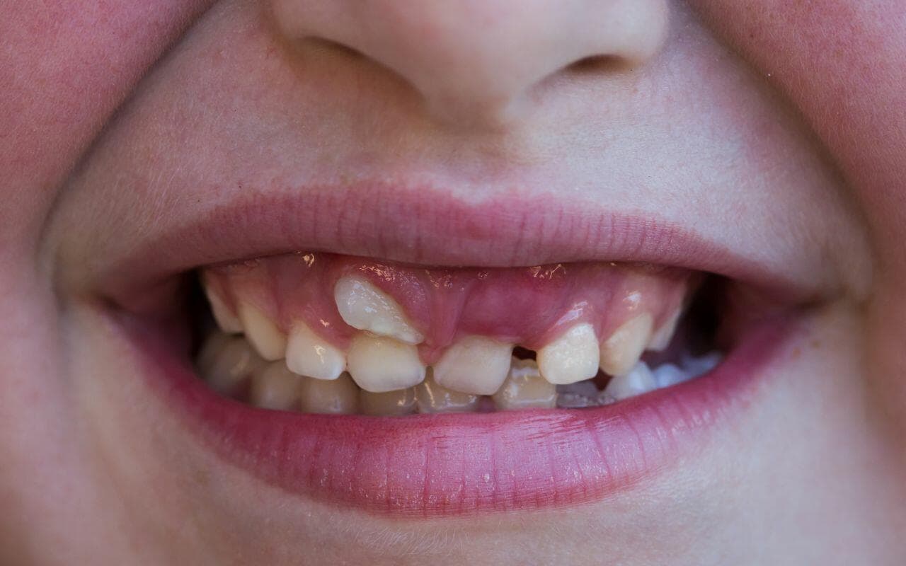 How Children's Teeth Erupt And Fall Out - Bradford Family Dentistry