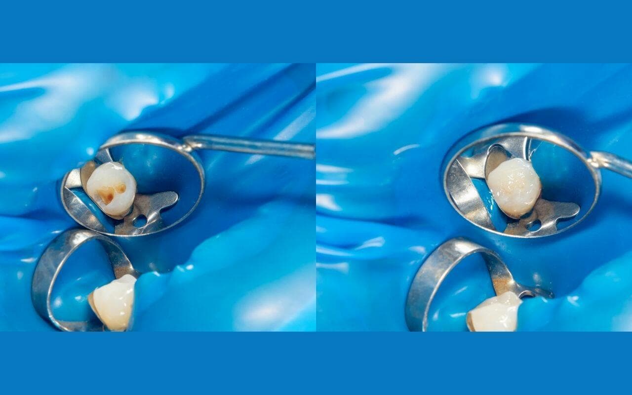Pros And Cons Of Different Types Of Dental Fillings - Bradford Family ...