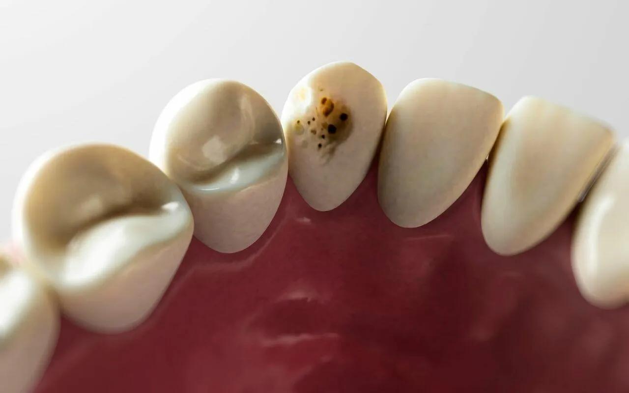 tooth decay one of the most common dental problems - Bradford Family ...