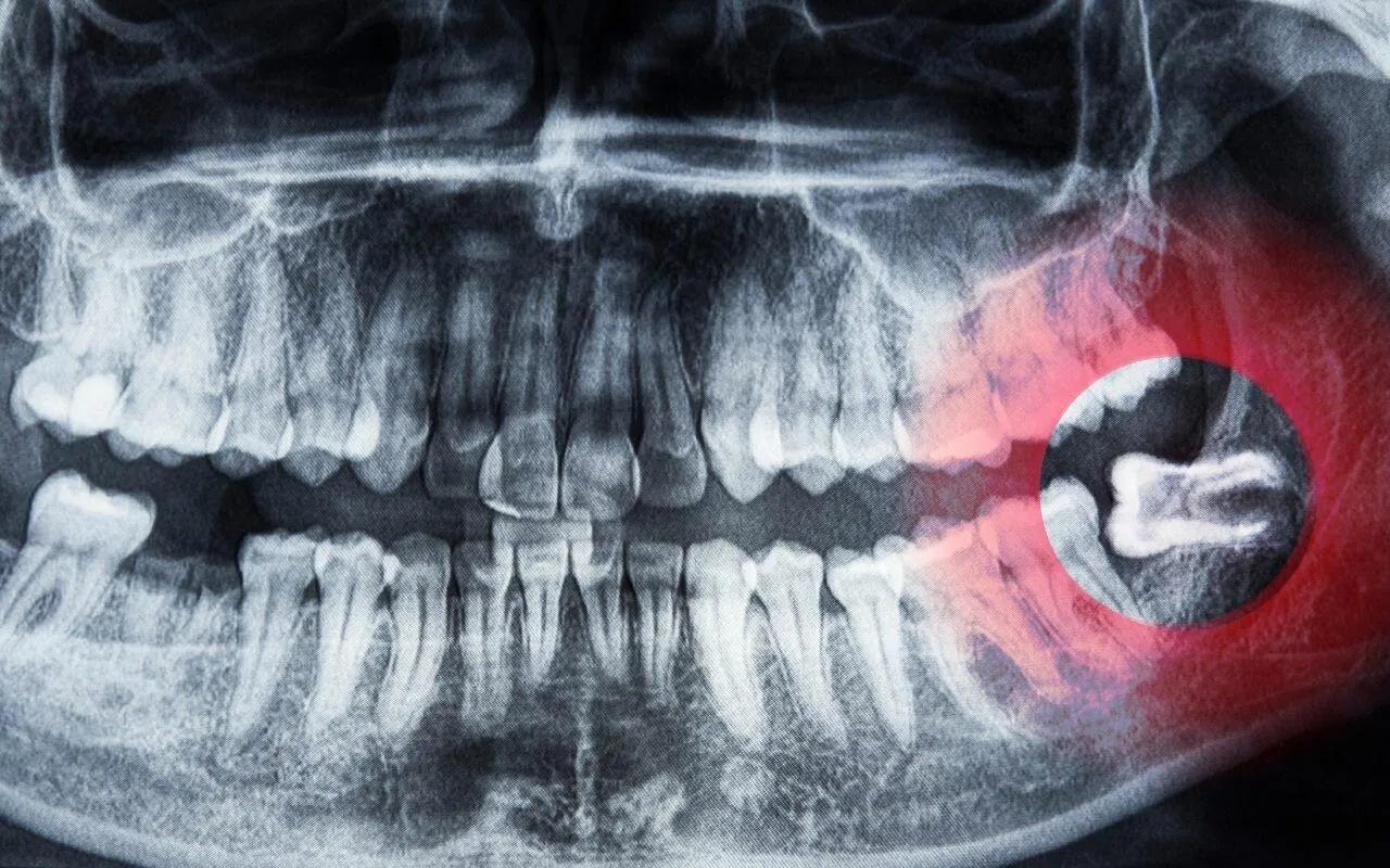 what are impacted wisdom teeth - Bradford Family Dentistry