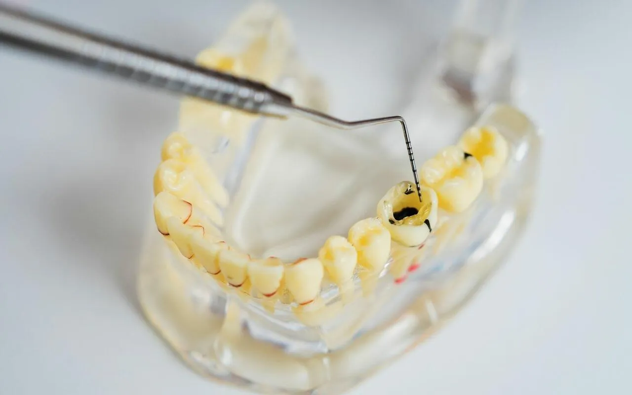 Pros And Cons Of Different Types Of Dental Fillings - Bradford Family ...