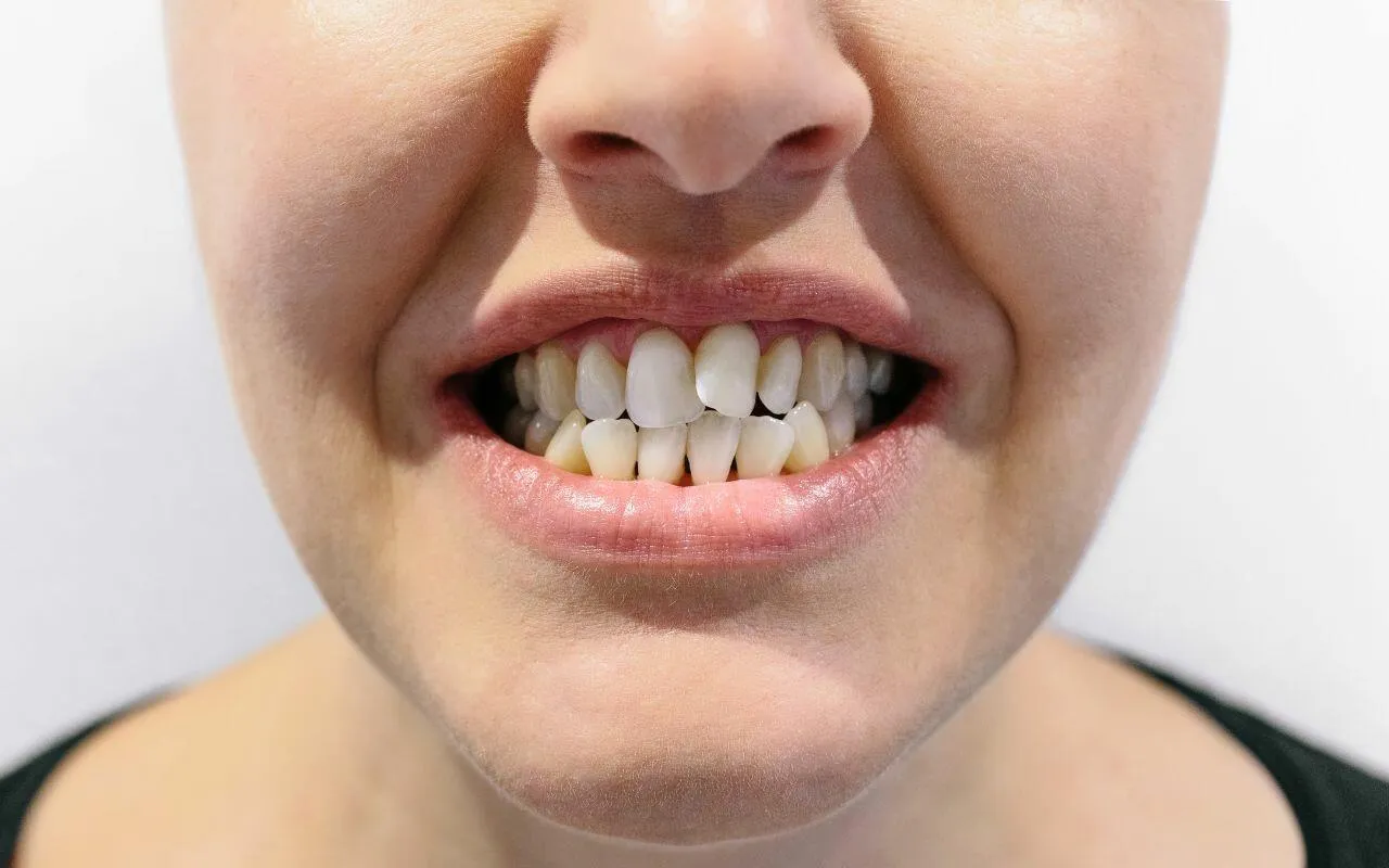 Braces Before And After - Bradford Family Dentistry